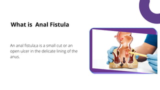 Know more about anal fistula | PPT