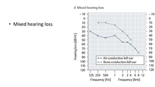 hearing-loss.ppt