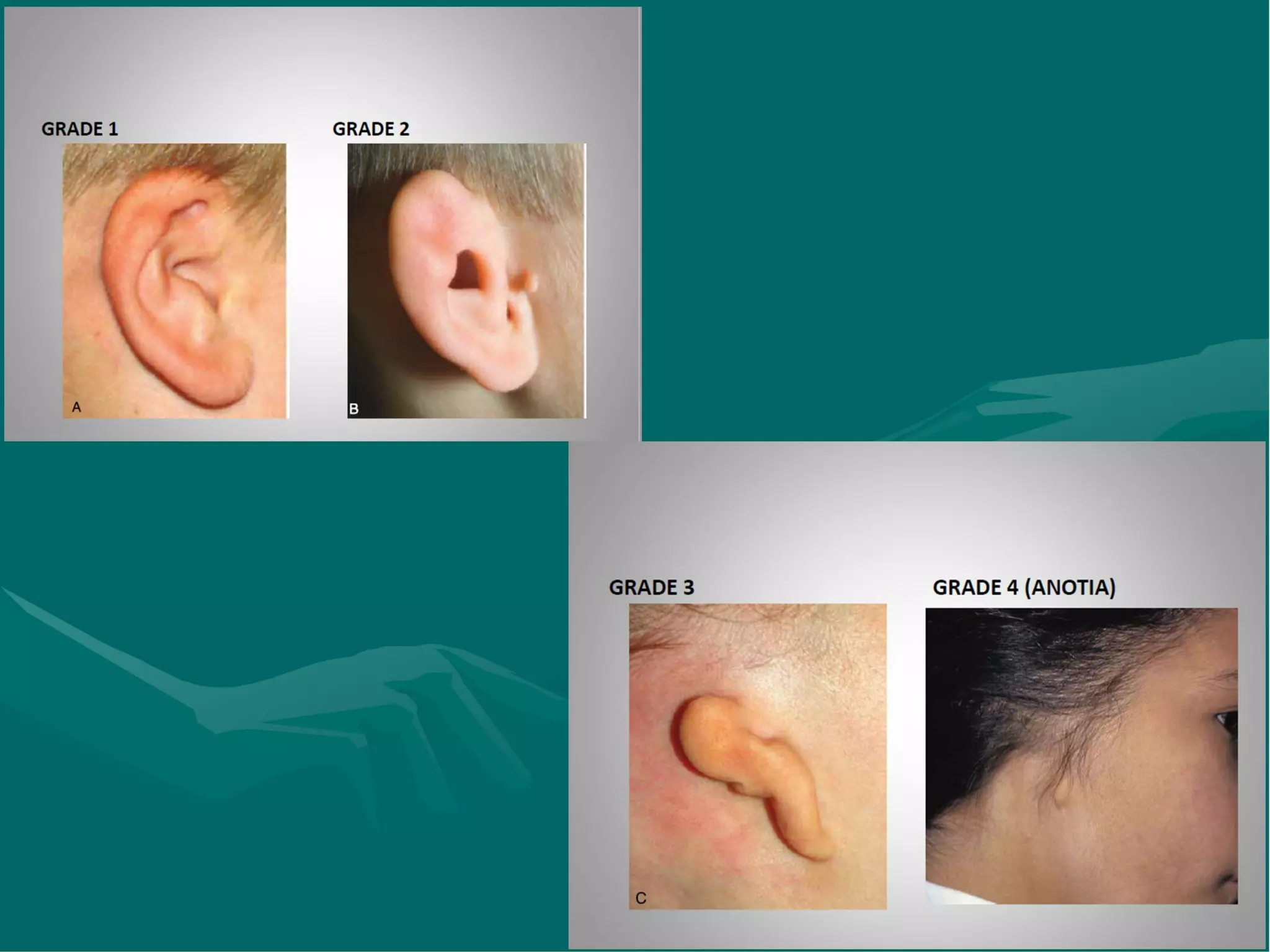 Hearing abnormalities | PDF