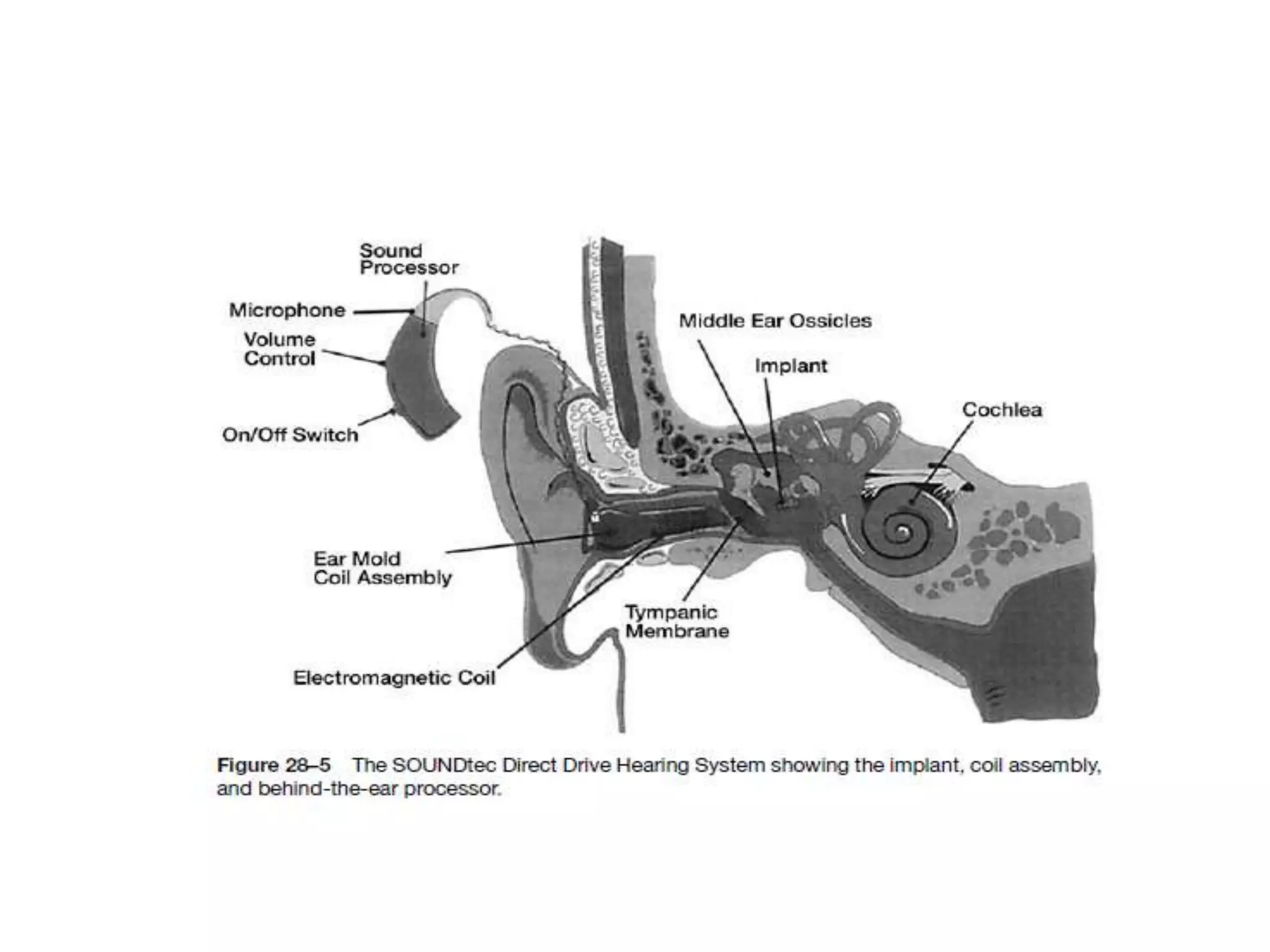 Hearing aids and cochlear implants.pptx