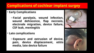 Hearing aids and cochlear implant Dr.Krishna Koirala .pptx
