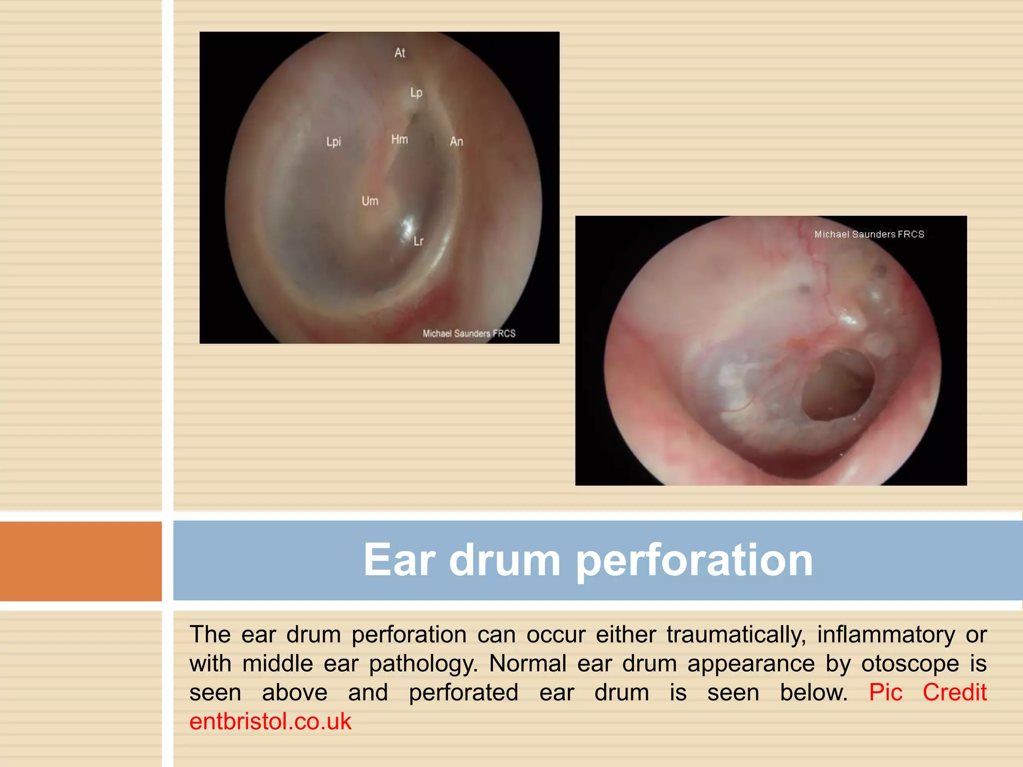 Hearing impairment | PPTX