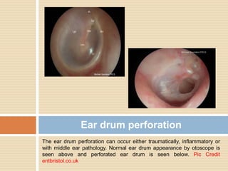 Hearing impairment ppt | PPTX