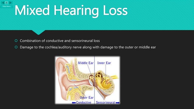 Hearing loss | PPT