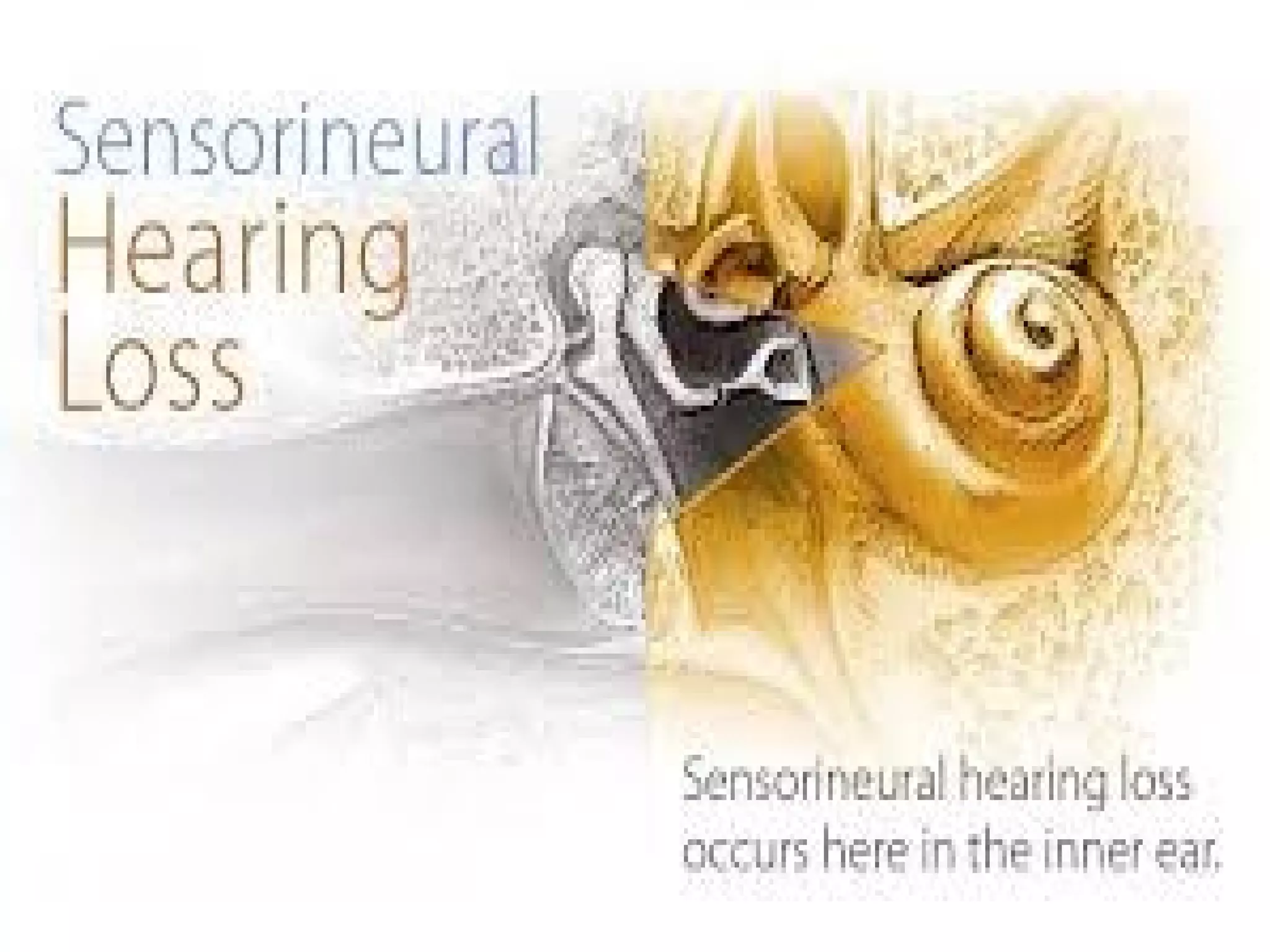 Hearing loss | PPT