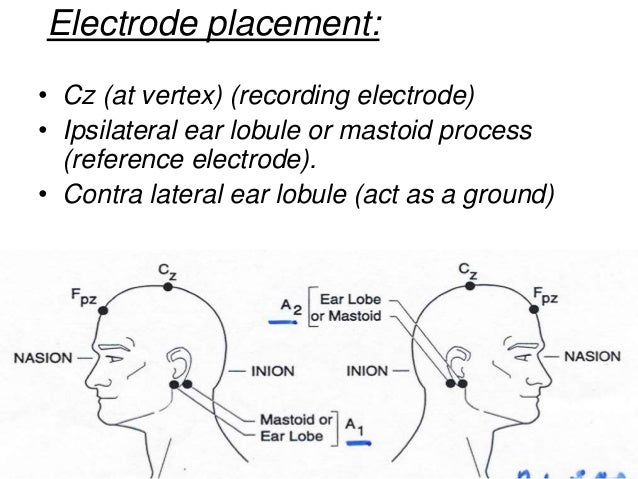 Hearing screening newborn