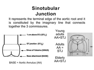 Sinotubular Junction