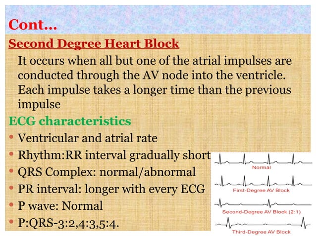Heart---------Block presentation in detail | PPT