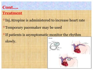 Heart---------Block presentation in detail | PPT