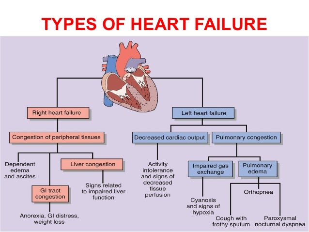 Congestive Heart Failure Treatment Options