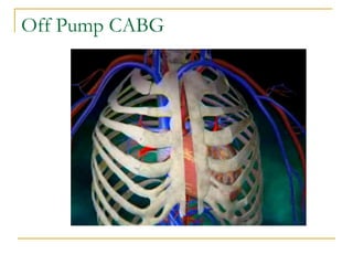 heart-lung-machine-pump.ppt