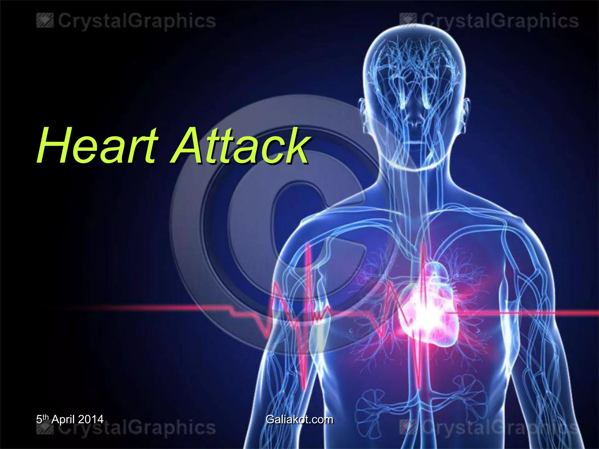 Heart attack | PPTX