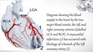 Heart attack | PPTX