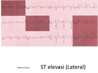 Heart Attack Also called: myocardial infarction | PPTX