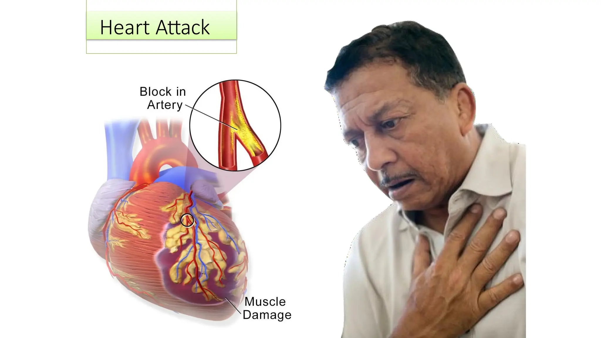 Understanding First Aid For Heart Attack | PPTX