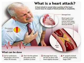 Heart attack | PPT