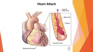 Heart Attack and Stroke powerpoint .pptx