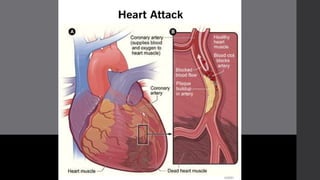 Heart Attack and Stroke updated version.pptx