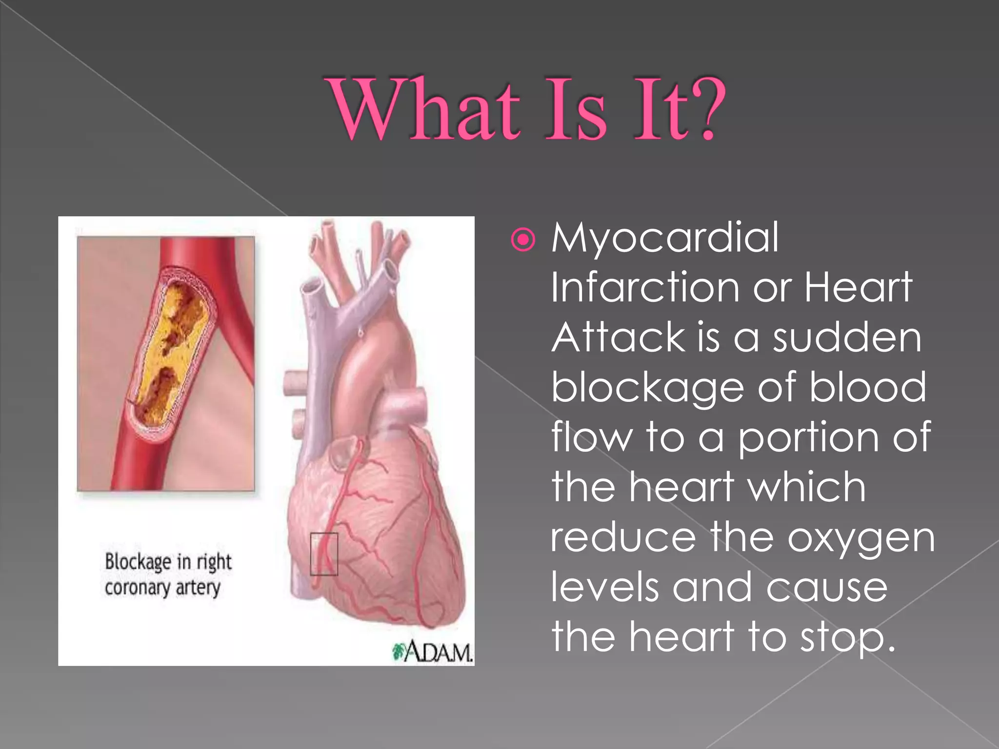 Heart attack ppt | PPTX