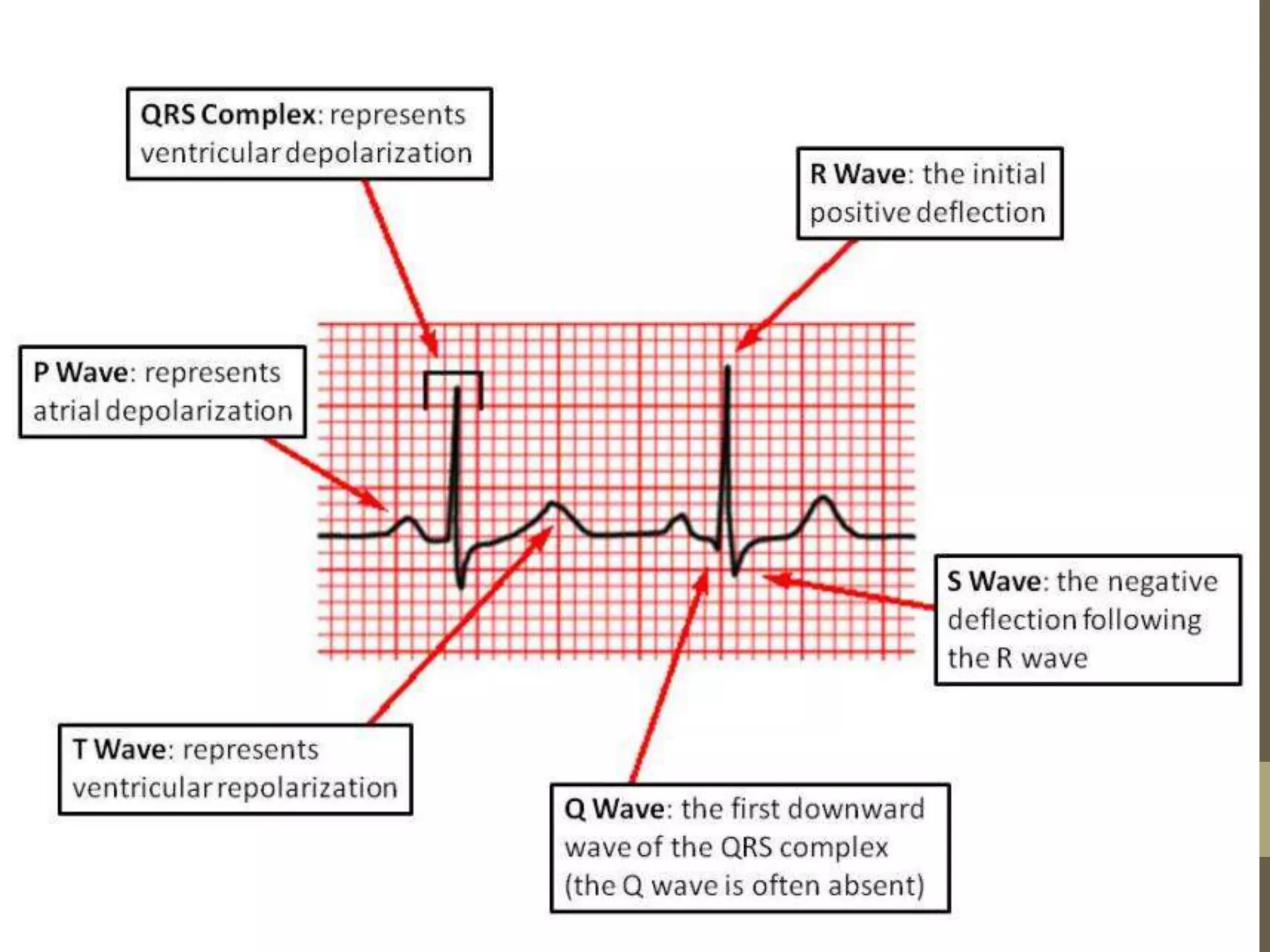 Heart block | PPTX