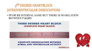 Heart block | PPTX