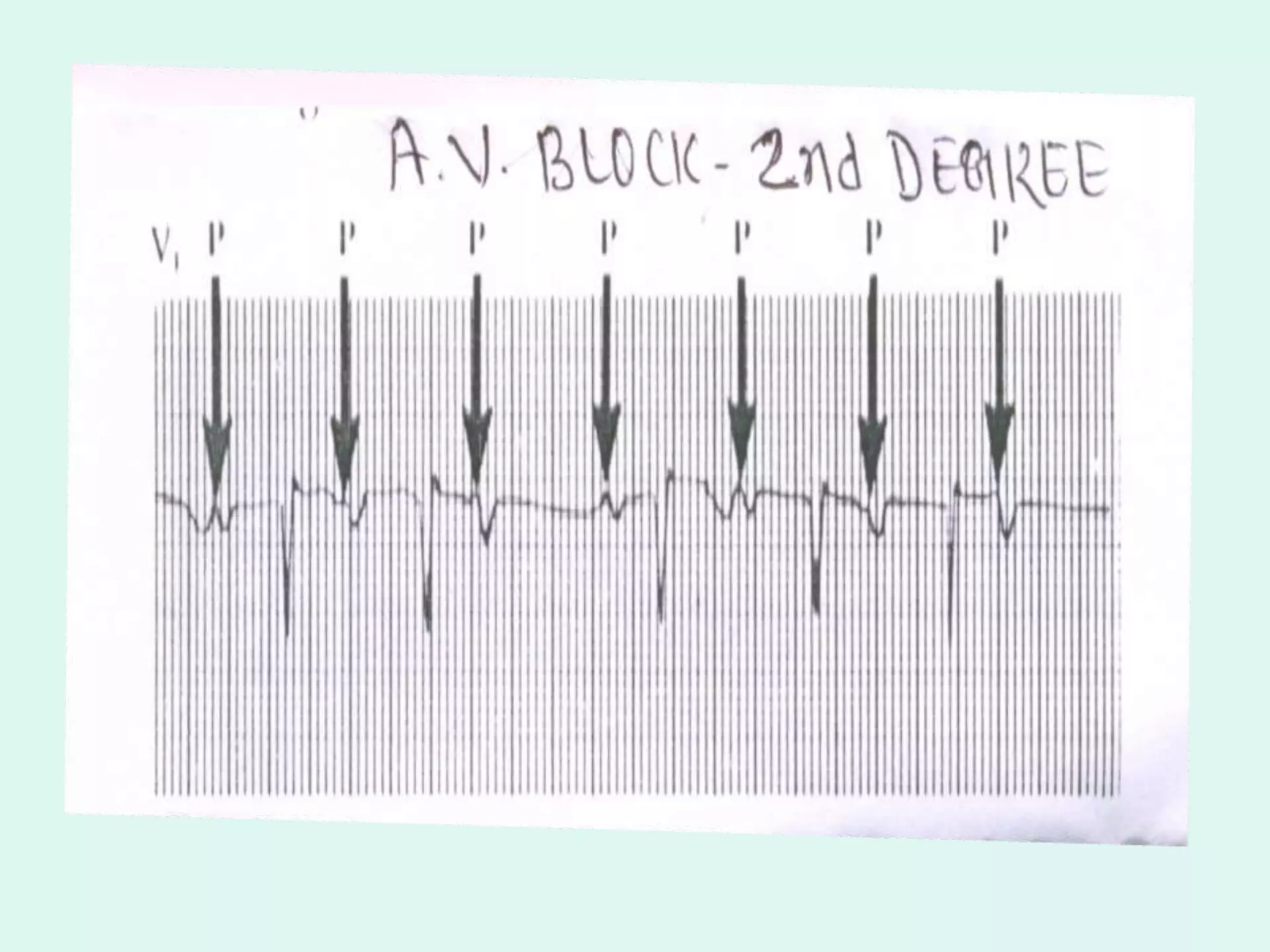 Heart block | PPT