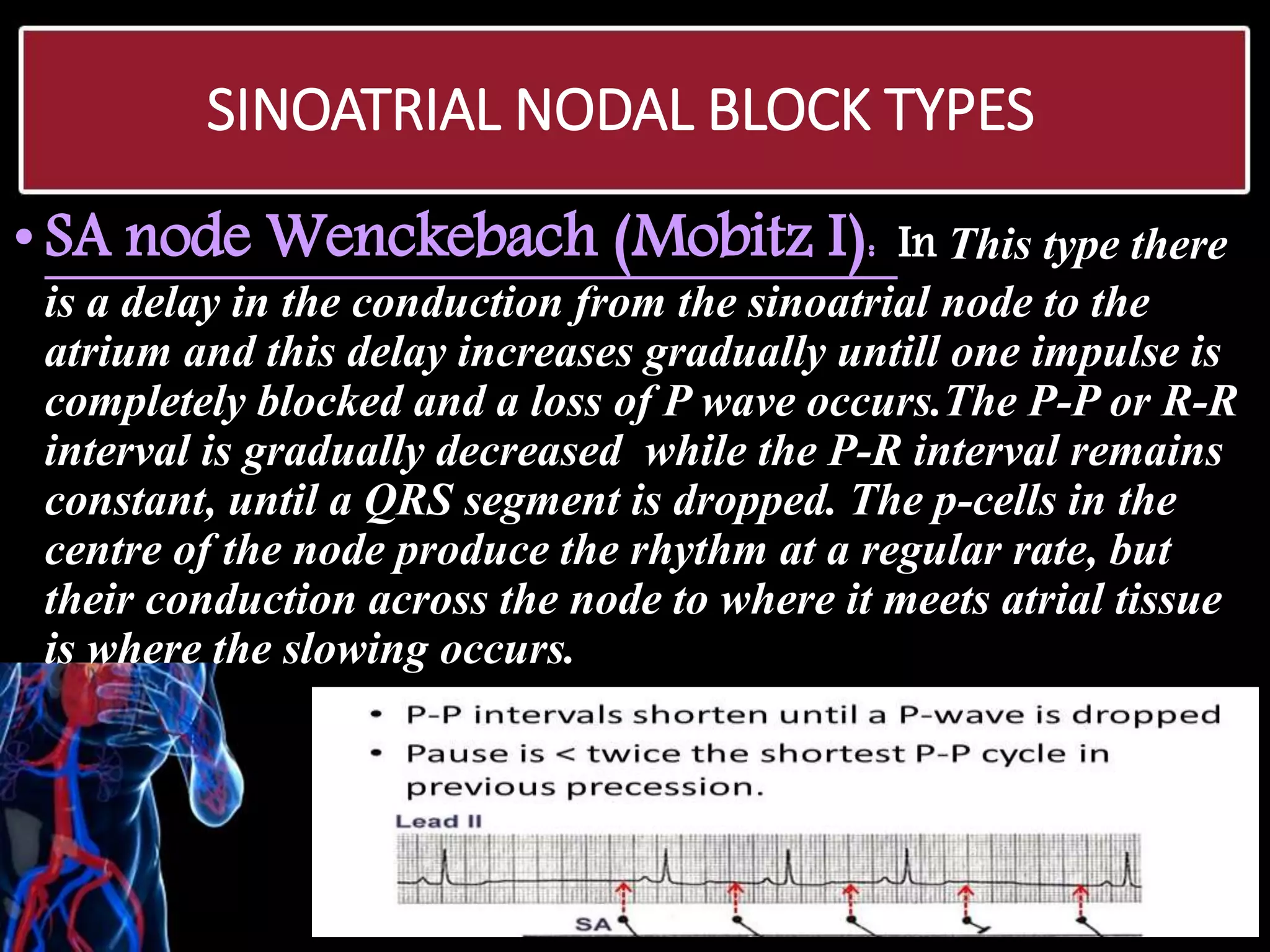 Heart block | PPT
