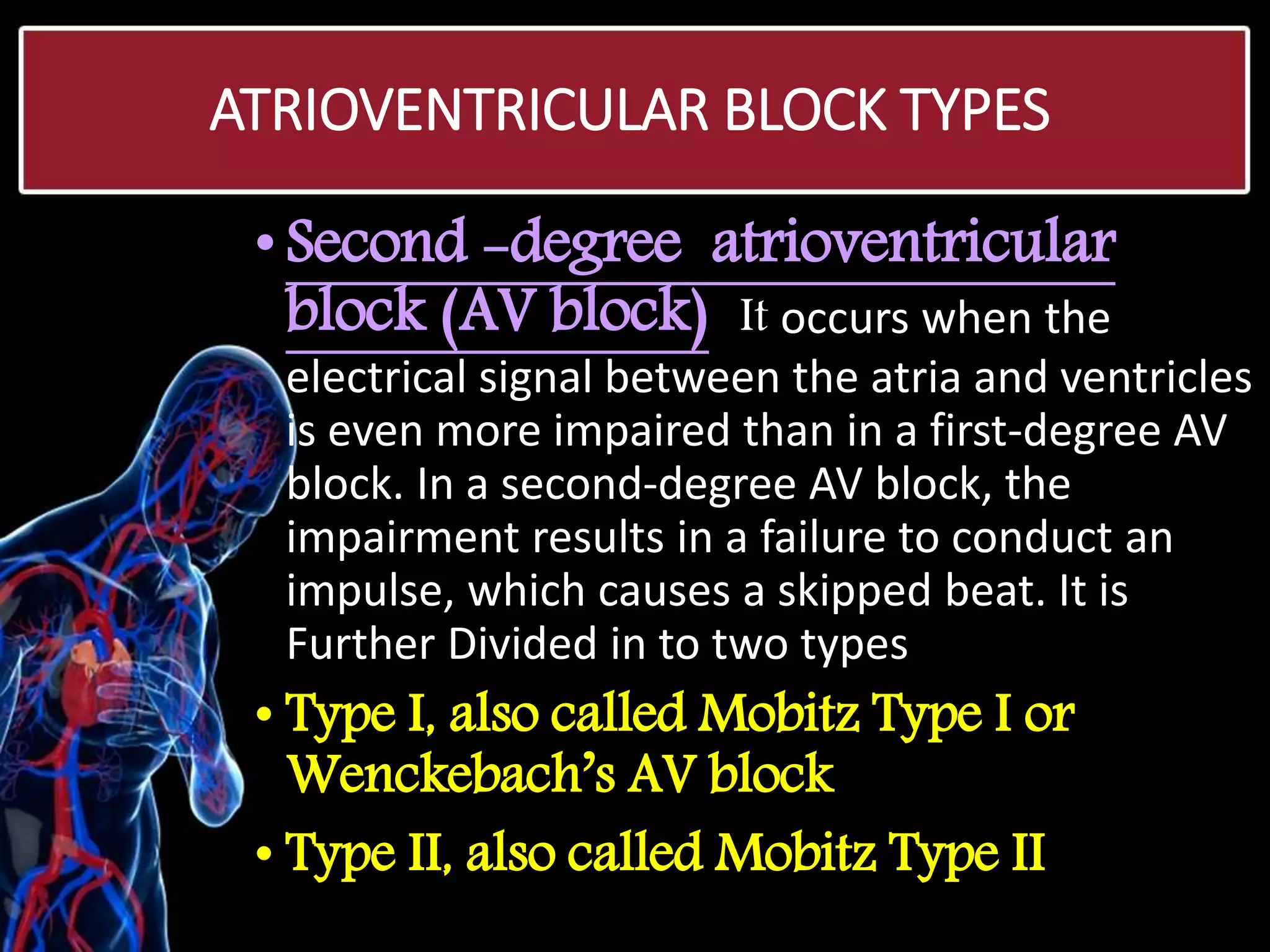Heart block | PPT