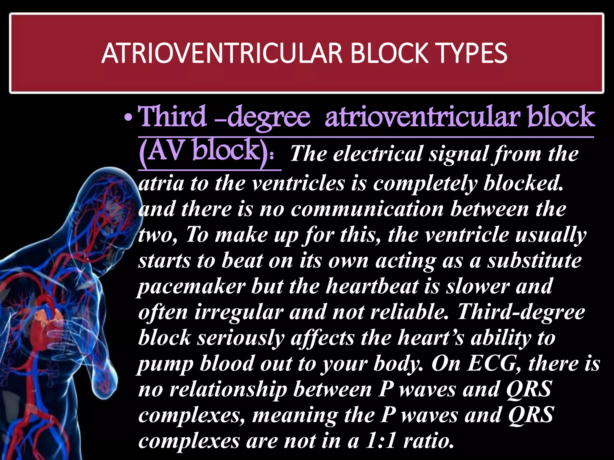 Heart block | PPT