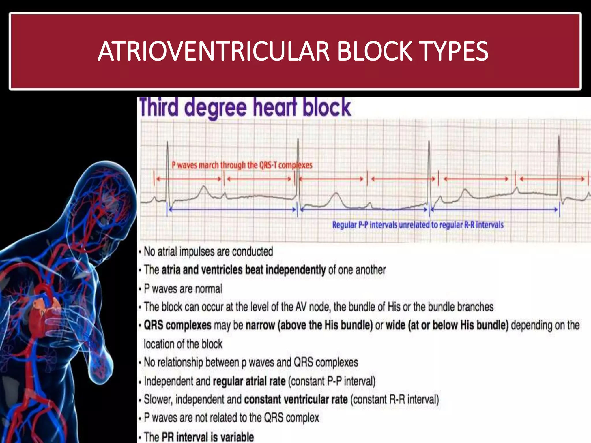 Heart block | PPT