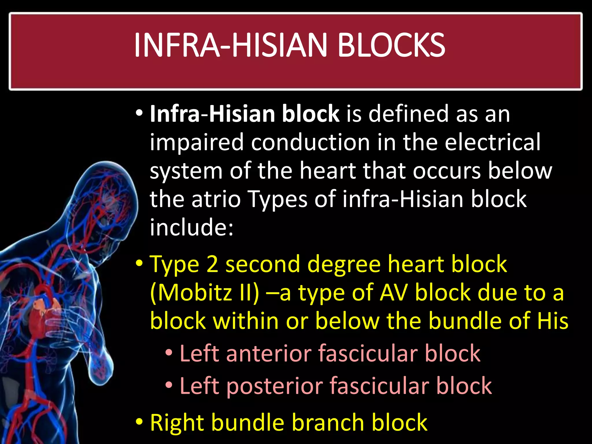 Heart block | PPT