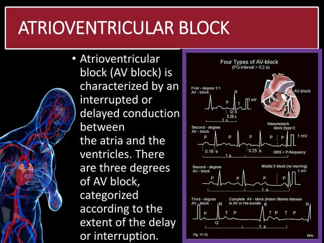 Heart block | PPT