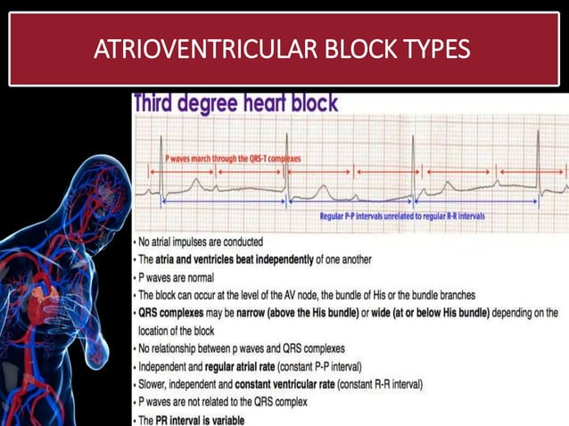 Heart block | PPT
