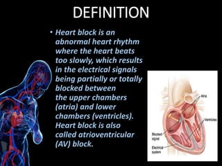 Heart block | PPT