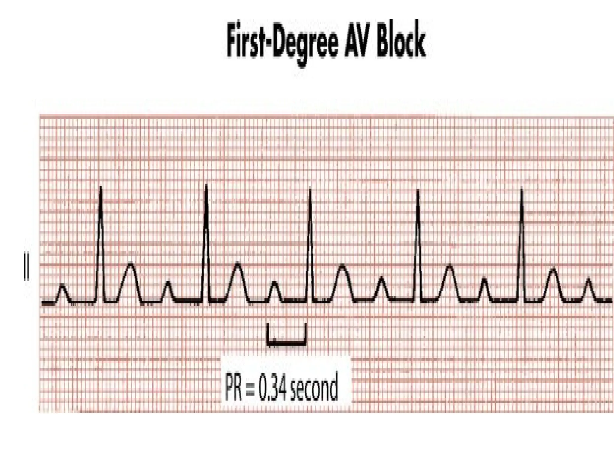Heart block,types,causes and management .pptx