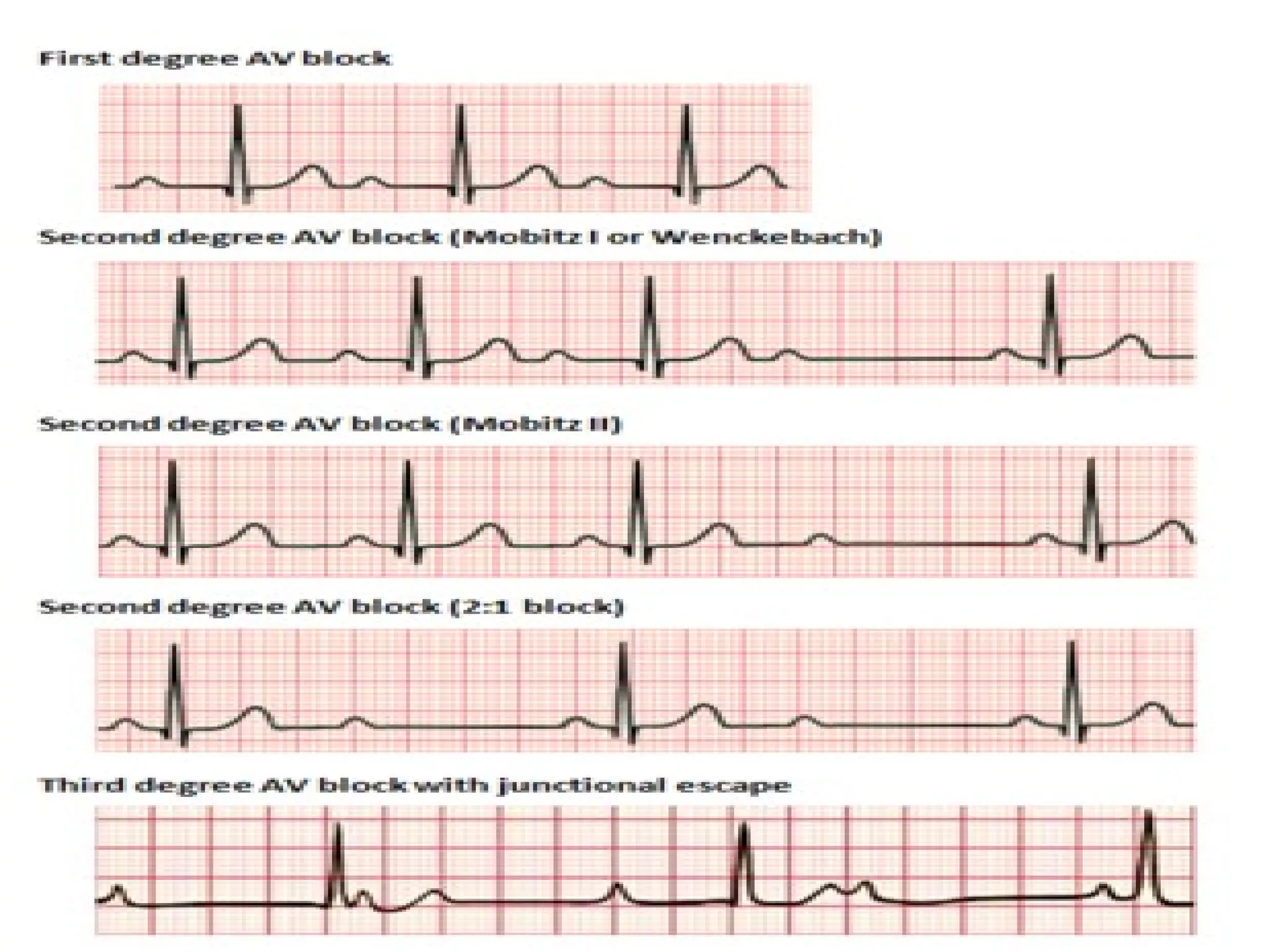 Heart block,types,causes and management .pptx