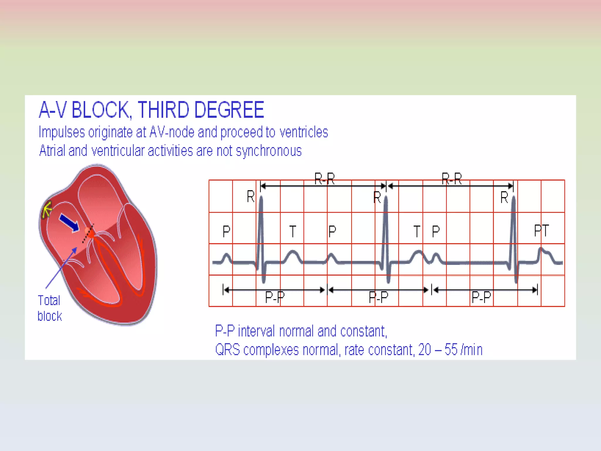 Heart block and ECG | PPTX