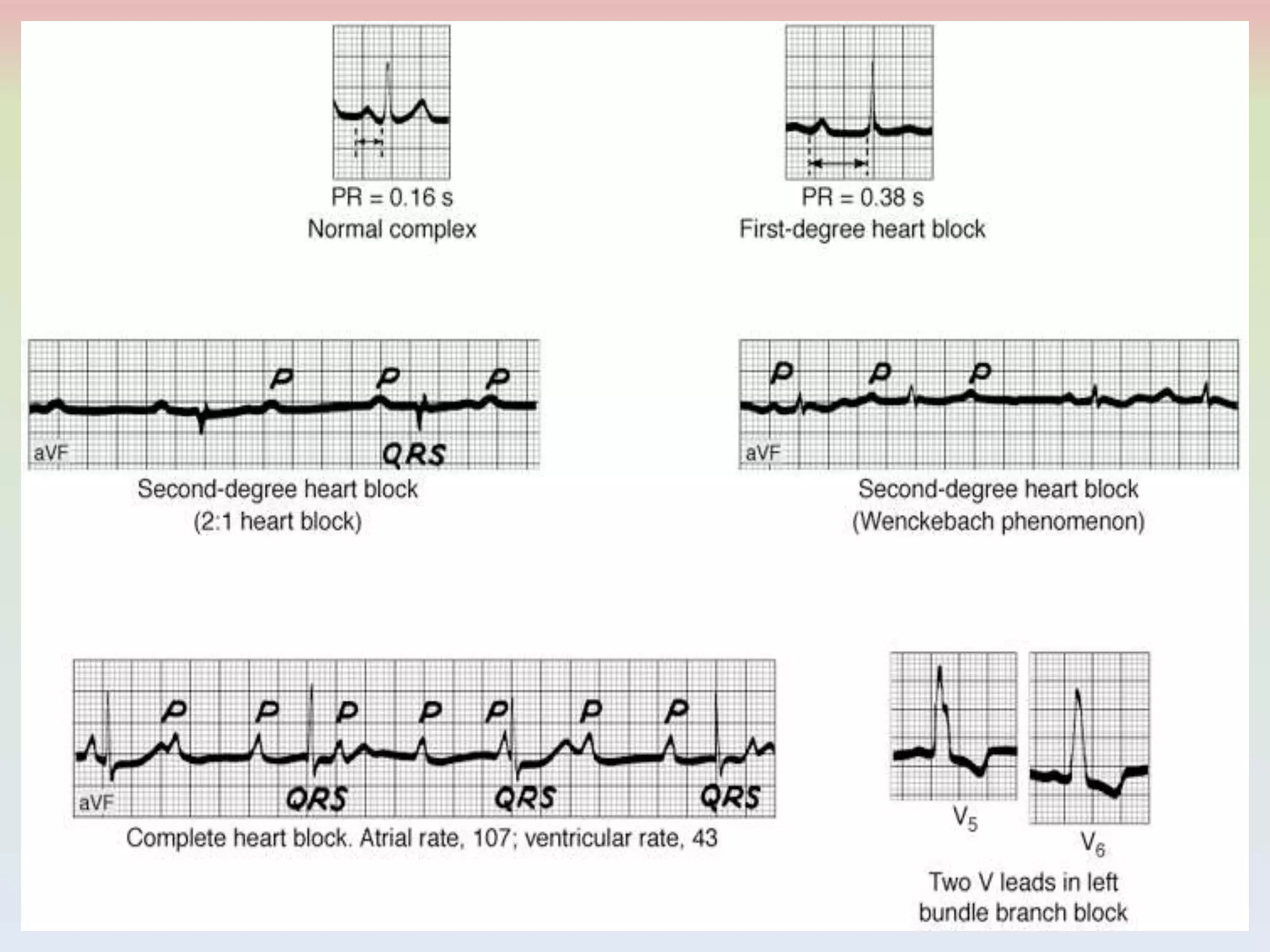 Heart block and ECG | PPTX