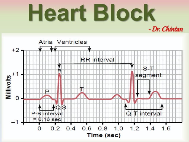 Heart block and ECG | PPTX | Heart and Cardiovascular Diseases ...