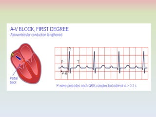Heart block and ECG | PPTX