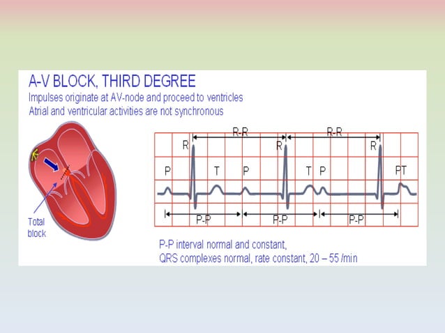 Heart block and ECG | PPTX | Heart and Cardiovascular Diseases ...