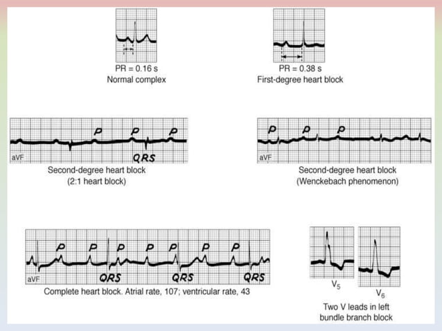 Heart block and ECG | PPTX | Heart and Cardiovascular Diseases ...