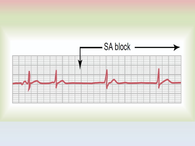 Heart block and ECG | PPTX | Heart and Cardiovascular Diseases ...