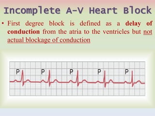 Heart block and ECG | PPTX