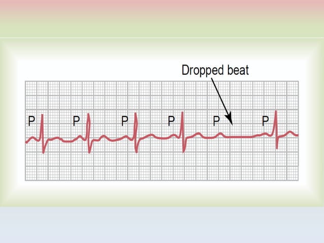 Heart block and ECG | PPTX | Heart and Cardiovascular Diseases ...