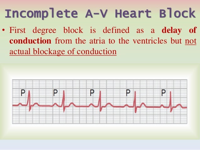 Heart block bds