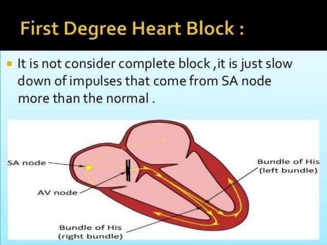 Heart block | PPTX | Heart and Cardiovascular Diseases | Diseases and ...