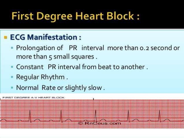 Heart block | PPTX | Heart and Cardiovascular Diseases | Diseases and ...