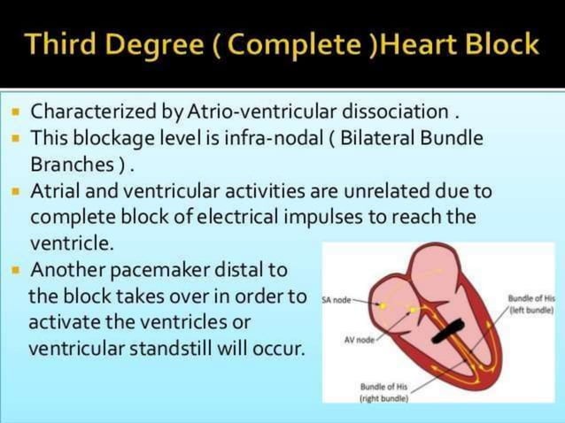 Heart block | PPT