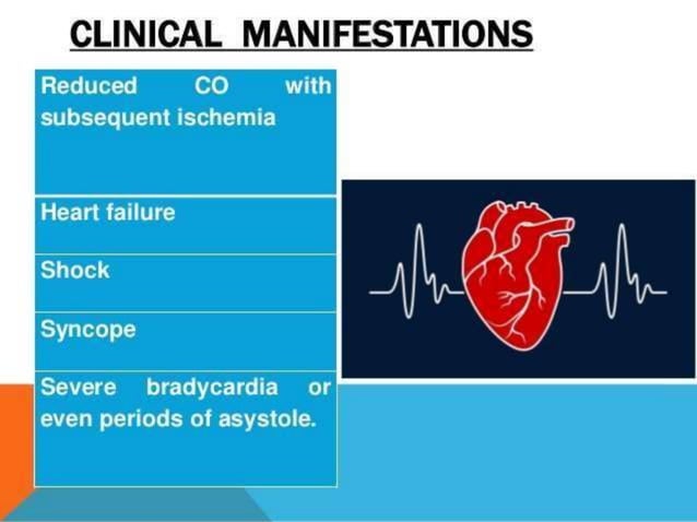 Heart block | PPT